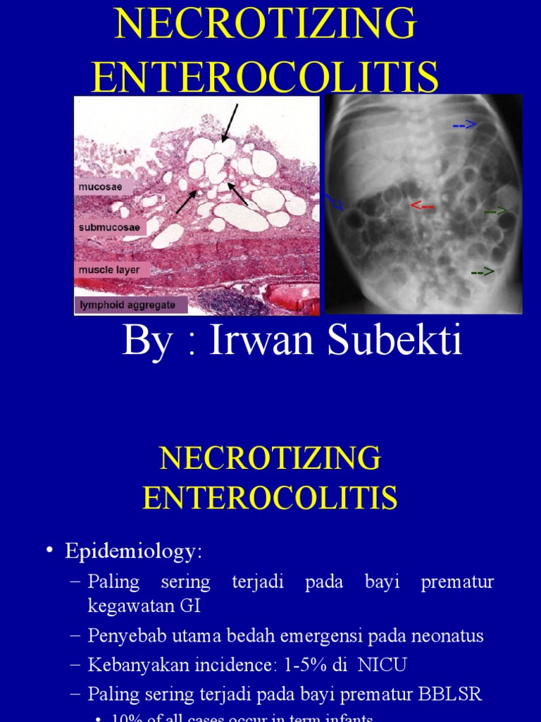Necrotizing Enterocolitis in Preterm and Full-Term Infants: A Case ...