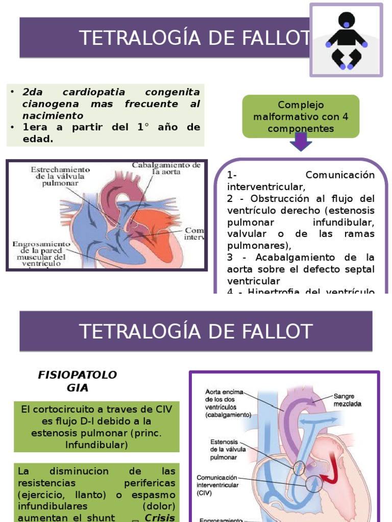 Tetralogia de Fallot | PDF