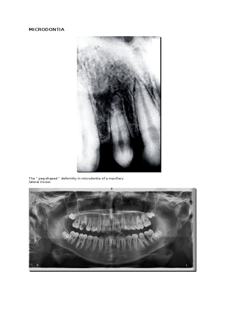 Microdontia: The " Peg-Shaped " Deformity in Microdontia of A Maxillary ...