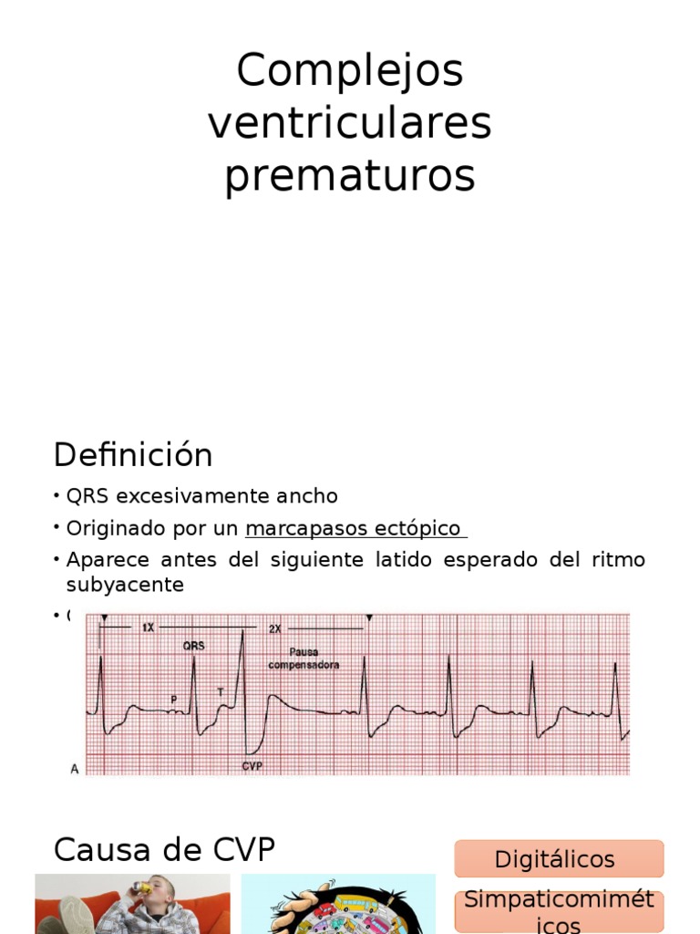 Complejos Ventriculares Prematuros | PDF