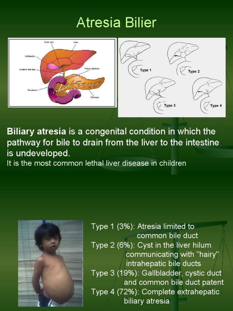 Atresia Bilier | PDF | Liver | Medical Specialties