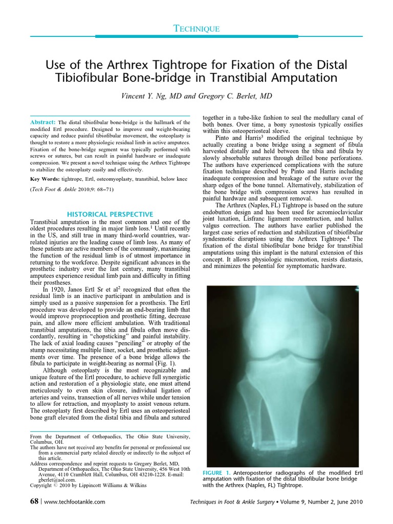 Fixation of The Distal Tibiofibular Bone-Bridge in Transtibial ...