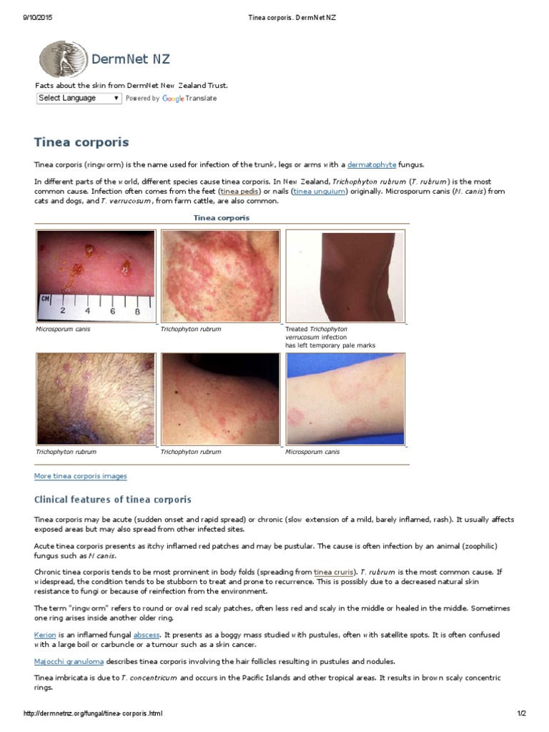 Tinea Corporis | PDF | Health Sciences | Immunology