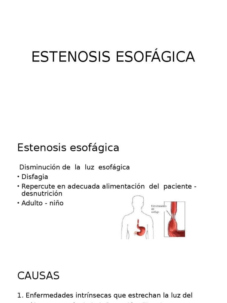 Estenosis Esofágica | PDF