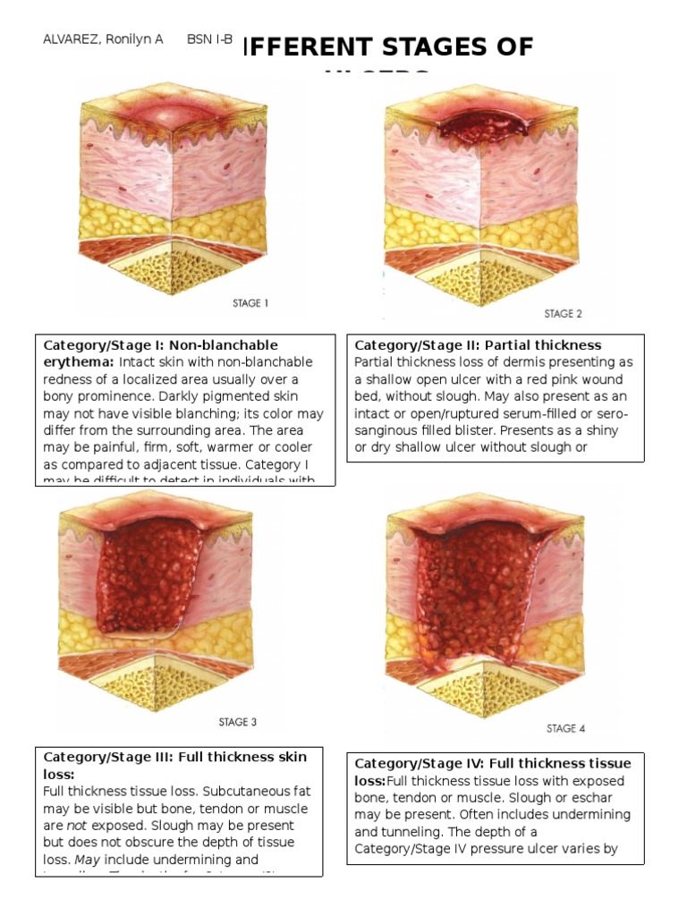 Different Ulcers | PDF | Skin | Dermatology
