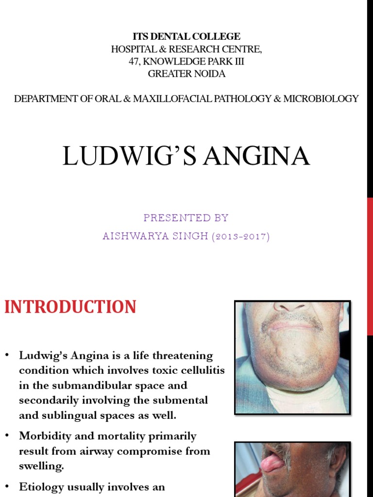 Ludwig’s Angina | Medical Specialties | Clinical Medicine