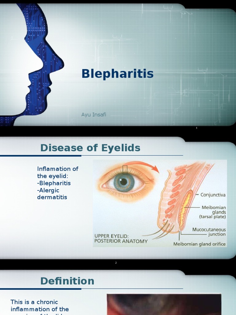Blepharitis: Ayu Insafi | PDF | Diseases And Disorders | Medical Specialties