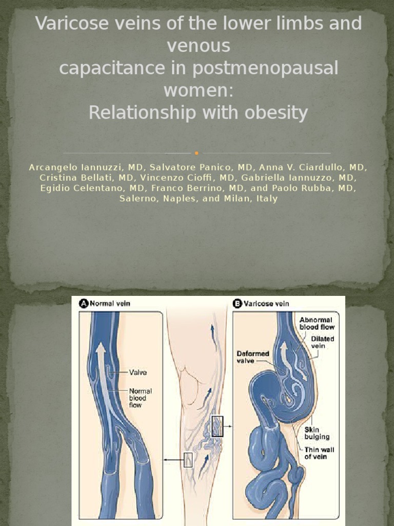 Varicose Vein | PDF