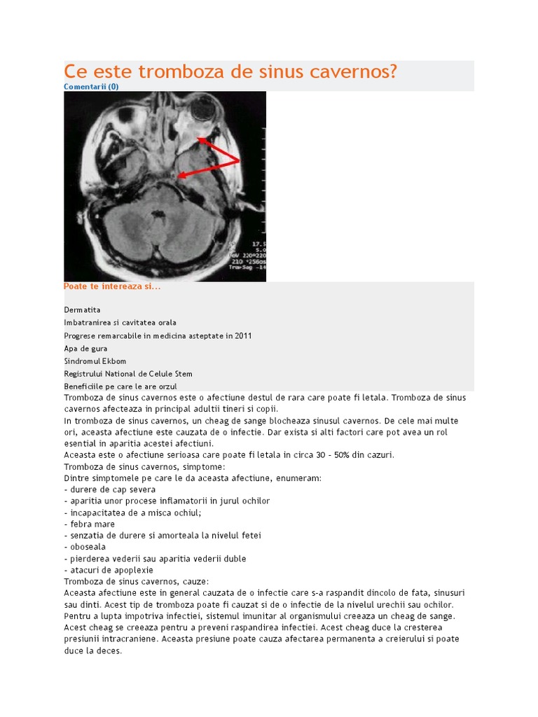 Ce Este Tromboza de Sinus Cavernos | PDF