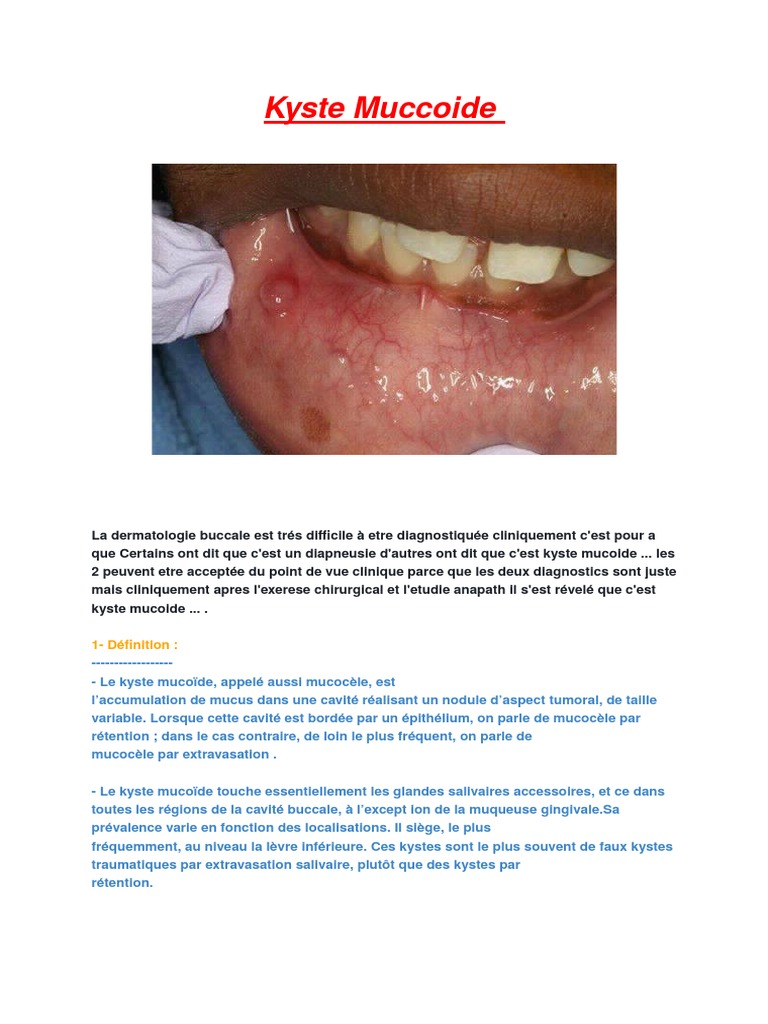 Kyste mucoïde : diagnostic et traitement | PDF | Maison et jardin ...