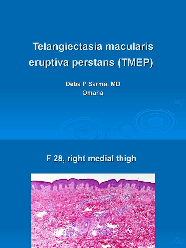Telangiectasia Macularis Eruptiva Perstans (TMEP) - F 28, Right Thigh ...