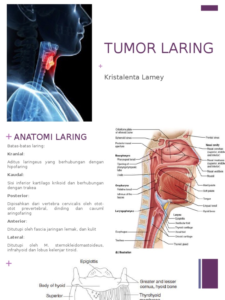 Tumor Laring | PDF