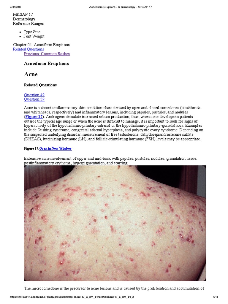 Acneiform Eruptions - Dermatology - MKSAP 17 | Acne Vulgaris | Health ...