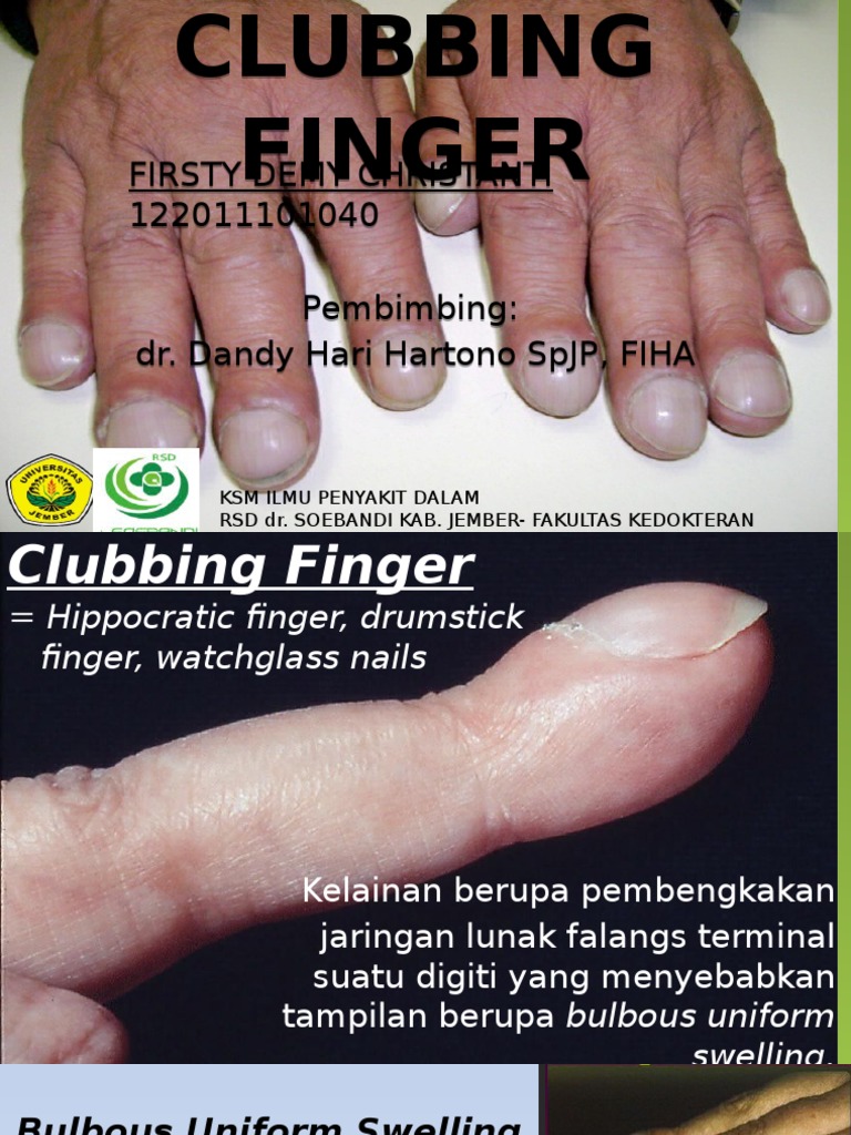 Clubbing Finger | PDF