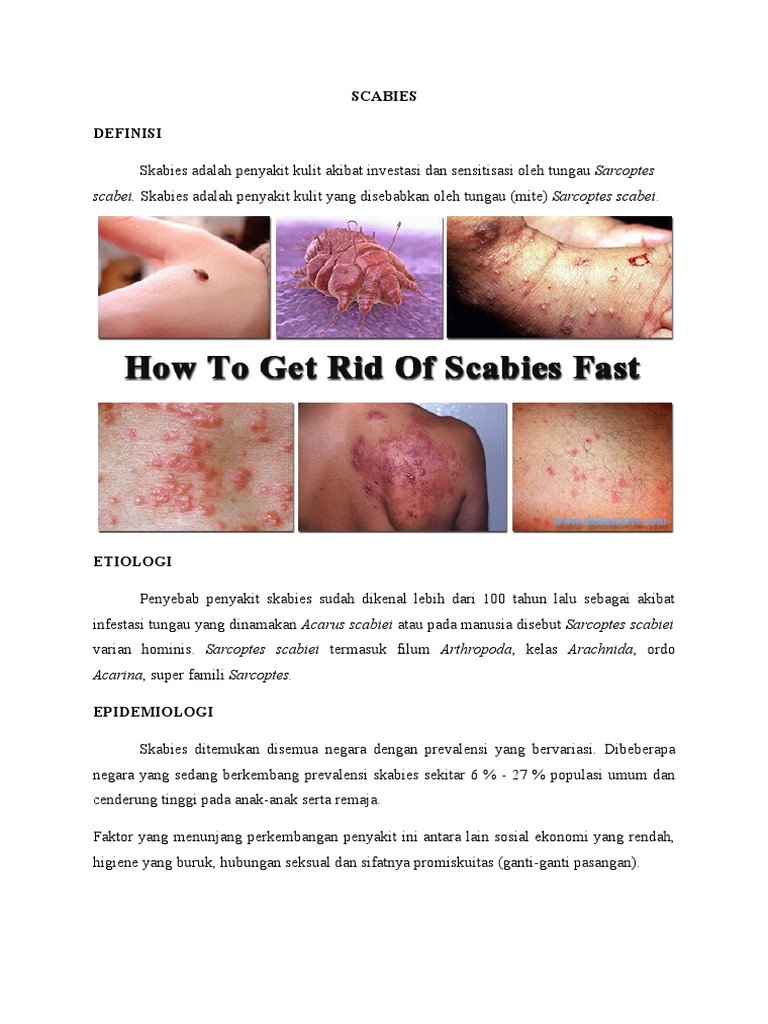 Scabies | PDF