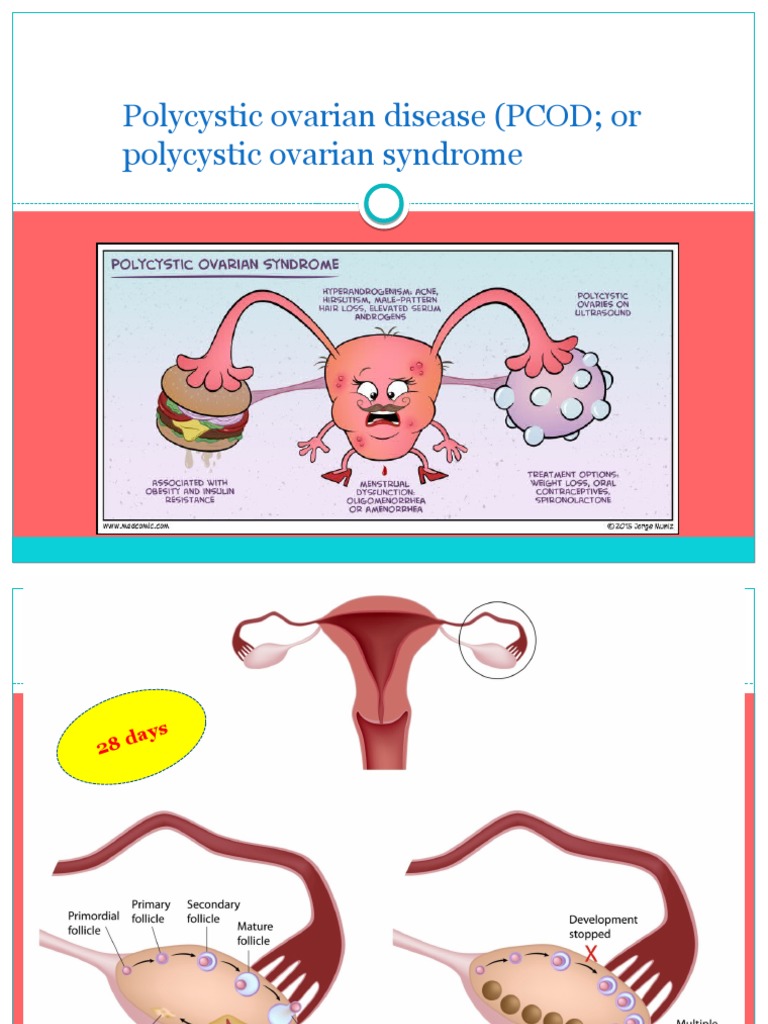 Polycystic Ovarian Disease (PCOD - 2 | PDF