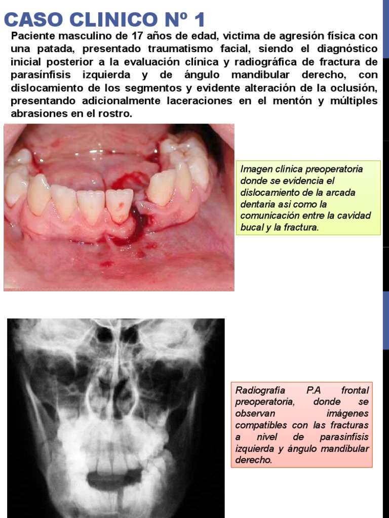 Fracturas Mandibulres | PDF | Enfermedades y trastornos | Medicina