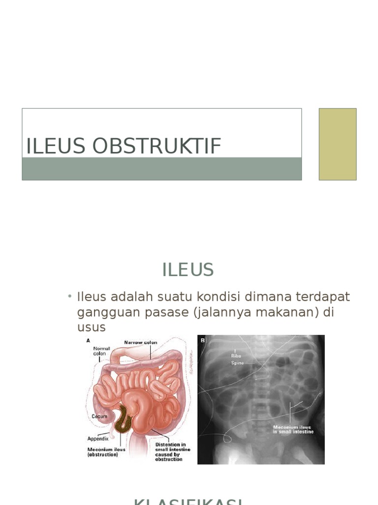Ileus Obstruktif: Klasifikasi dan Etiologi | PDF