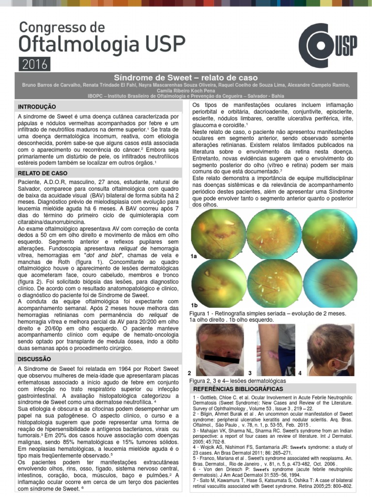 Síndrome Sweet - Ê-Poster | PDF | Olho | Medicina Clínica