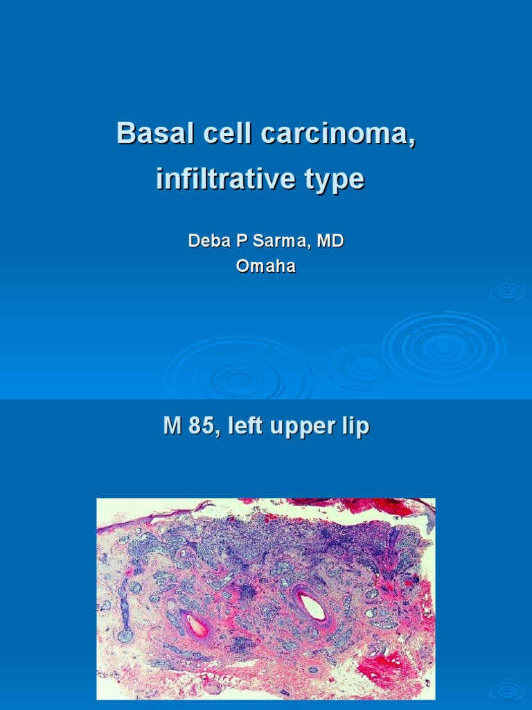 Infiltrative Basal Cell Carcinoma Overview | PDF | Science & Mathematics