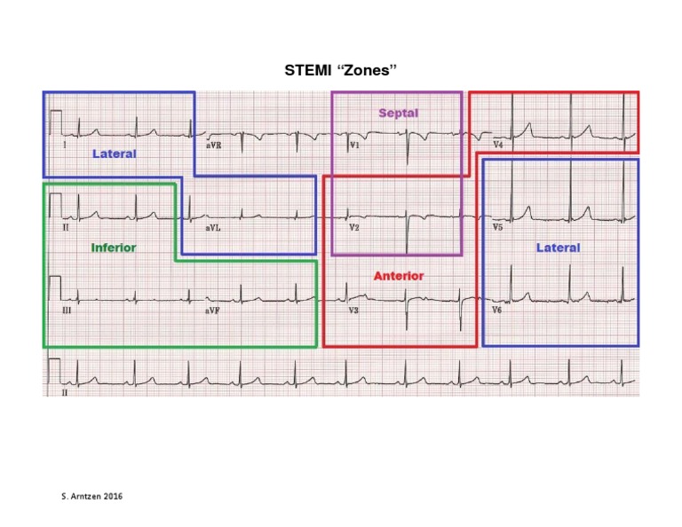 Stemi "Zones": S. Arntzen 2016 | PDF