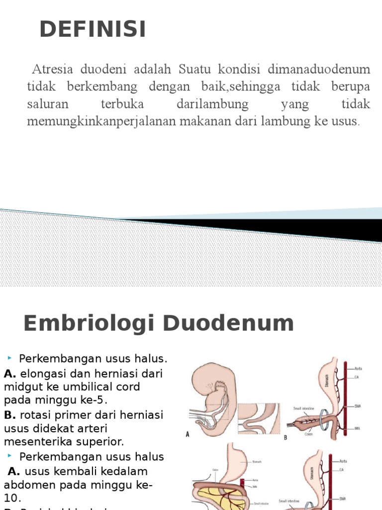Atresia Duodenum | PDF