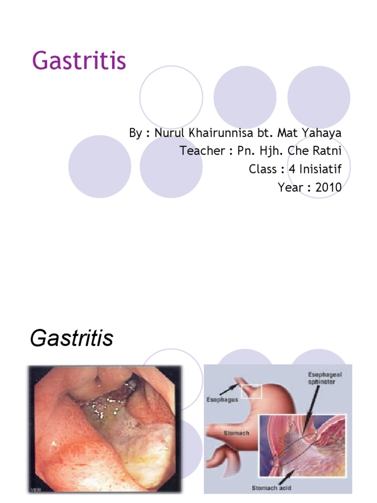 Gastritis: By: Nurul Khairunnisa Bt. Mat Yahaya Teacher: Pn. Hjh. Che ...