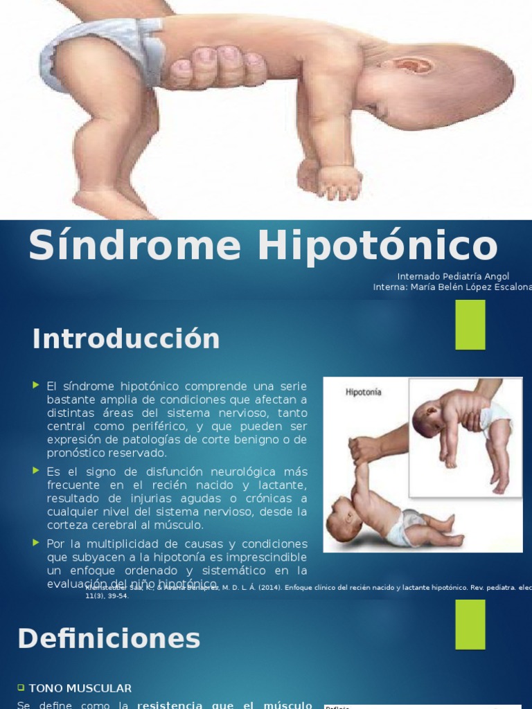 Síndrome Hipotónico | Neurología | Músculo