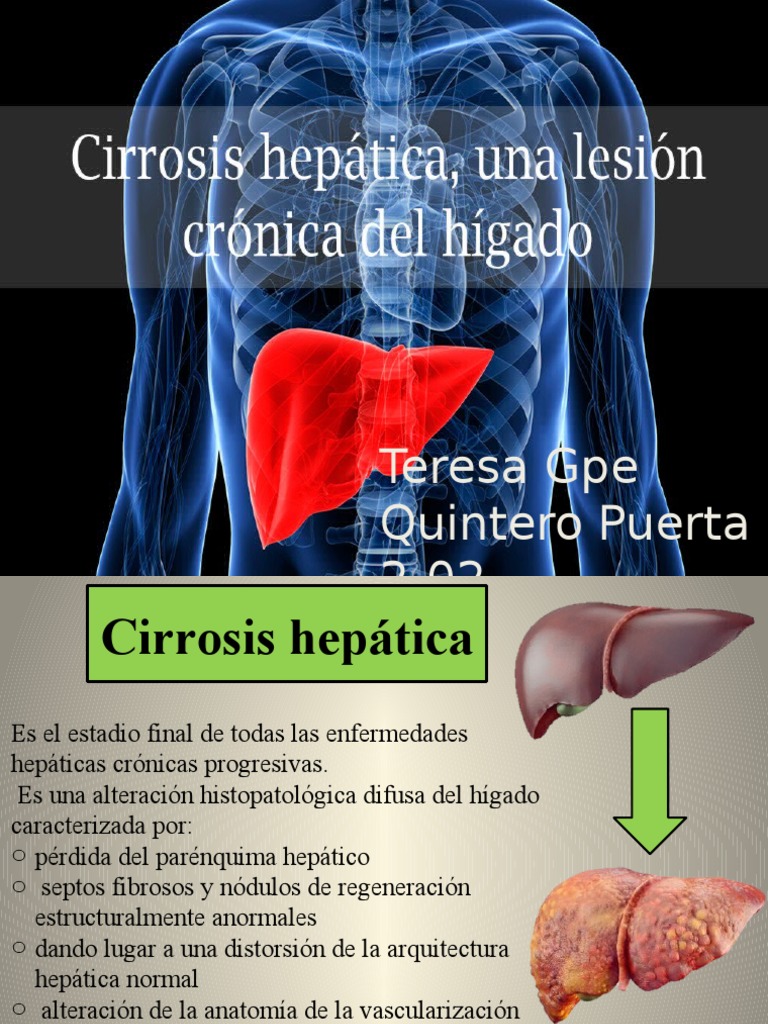 Cirrosis Hepatica | PDF | Cirrosis | Hepatitis