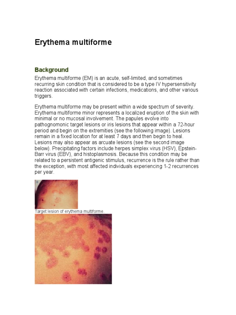 Erythema Multiforme | PDF | Infection | Herpes Simplex