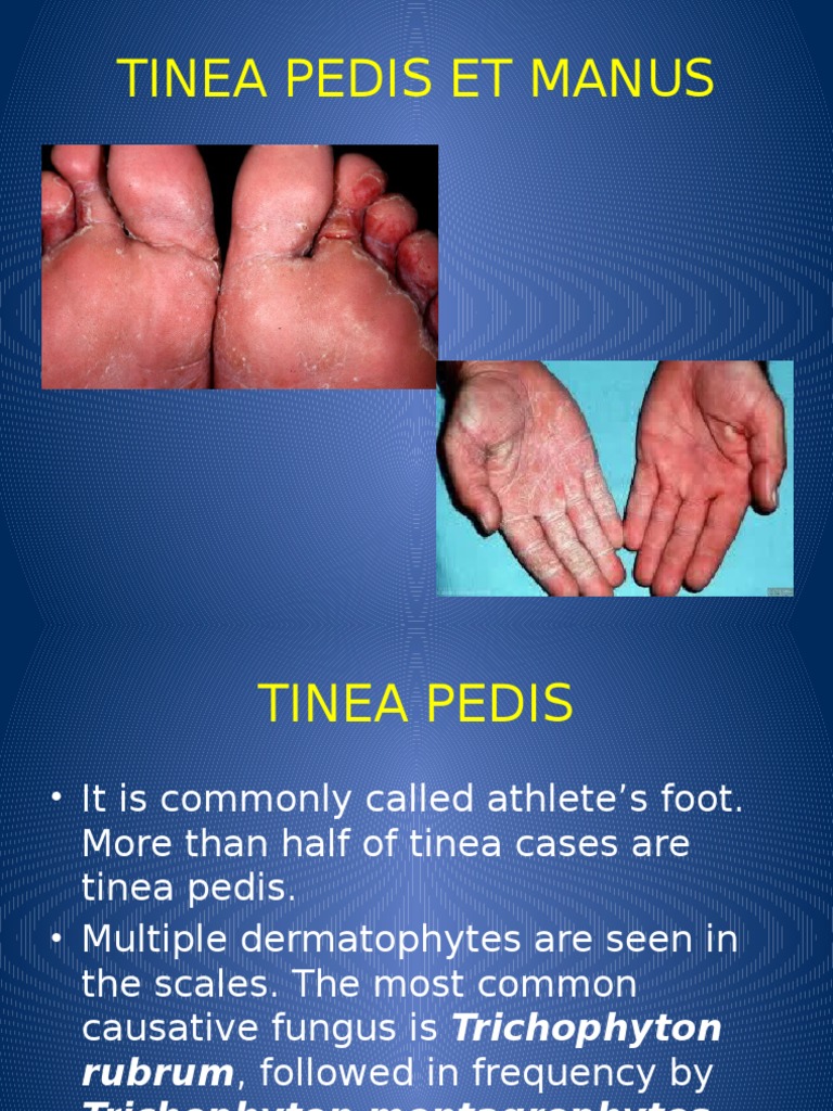 Types and Features of Tinea Pedis/Manuum | PDF | Animal Diseases ...
