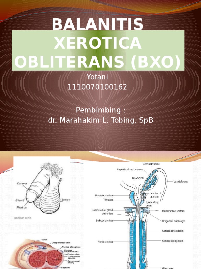 BALANITIS PPT