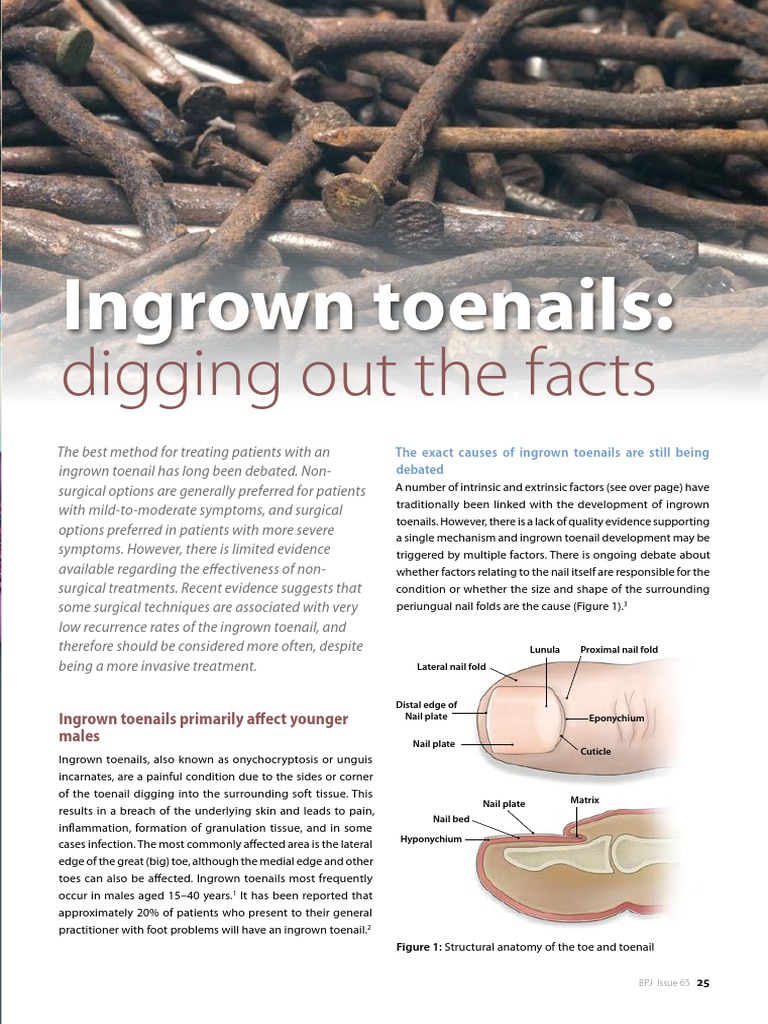 BPJ65 Ingrown Toenails | PDF | Nail (Anatomy) | Medical Specialties