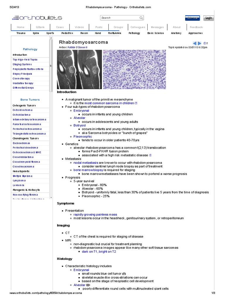 Rhabdomyosarcoma - Pathology - Orthobullets | PDF | Metastasis ...