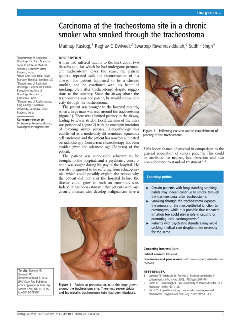 Tracheostomy Site Cancer | PDF | Psychiatry | Radiation Therapy