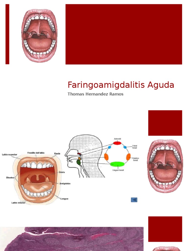 Faringoamigdalitis | Penicilina | Enfermedades y trastornos
