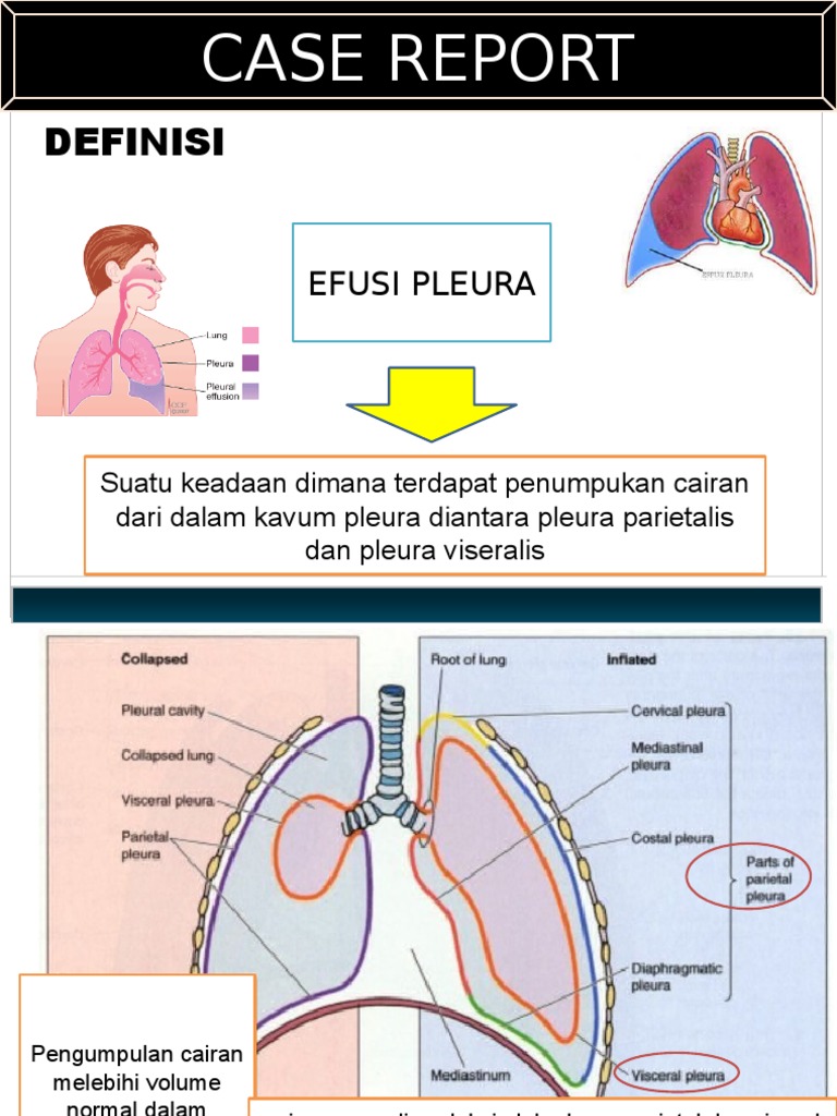 Efusi Pleura | PDF