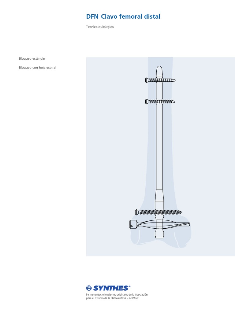 DFN Clavo Femoral Distal | PDF | Tornillo | Sistema musculoesquelético