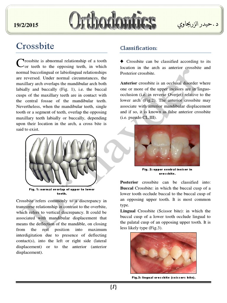 Crossbite: Classification | PDF | Human Head And Neck | Orthodontics