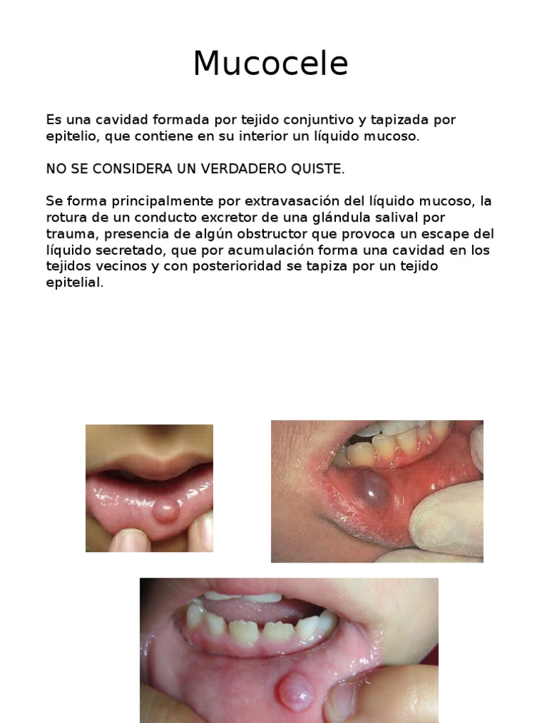 Iniciación Mucocele Ranula Sialolitiasis | PDF | Anatomía ...