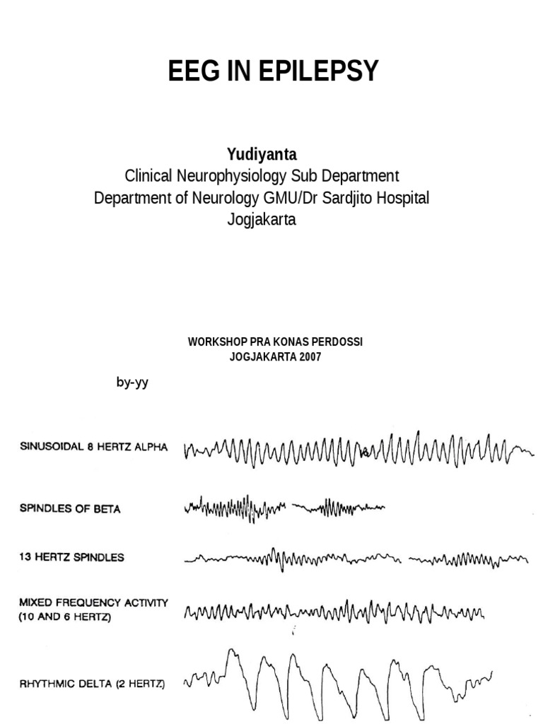 An In-Depth Review of EEG Patterns in Epilepsy: Identifying Interictal ...