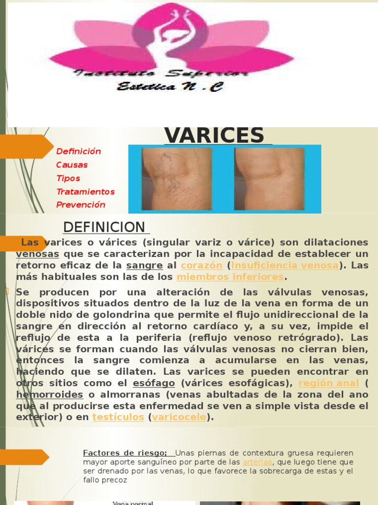 Varices | Venas varicosas | Epidemiología
