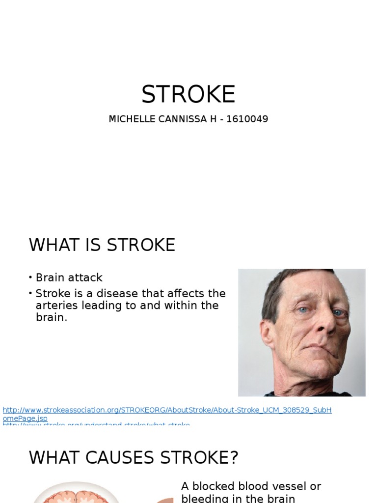 Understanding Stroke: Types and Causes | PDF