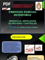 Protocolo Impresión Definitiva para Protesis Total | PDF | Dentadura ...
