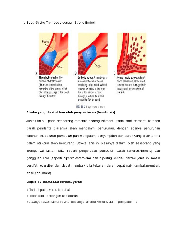 Beda Stroke Trombosis Dengan Stroke Emboli | PDF