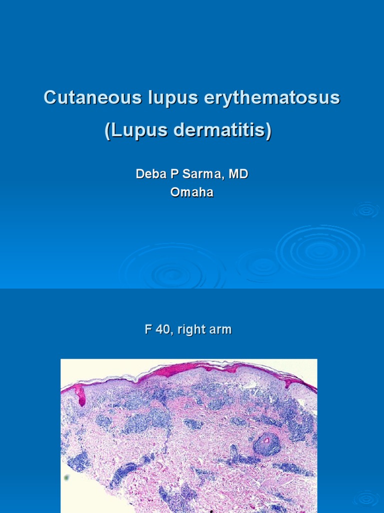 Cutaneous Lupus Erythematosus Overview | PDF | Science & Mathematics
