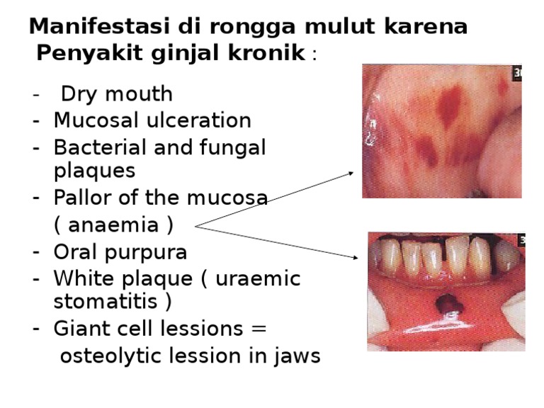 Manifestasi Di Rongga Mulut Ec CKD | PDF