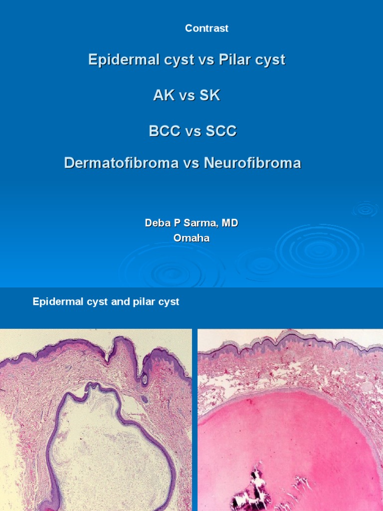 Contrast: Epidermal Cyst Vs Pilar Cyst, AK Vs SK, BCC Vs SCC ...