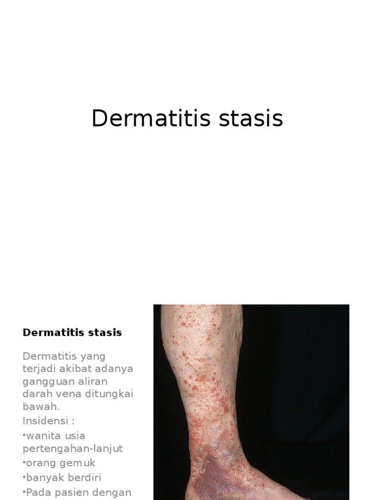 Dermatitis Stasis | PDF