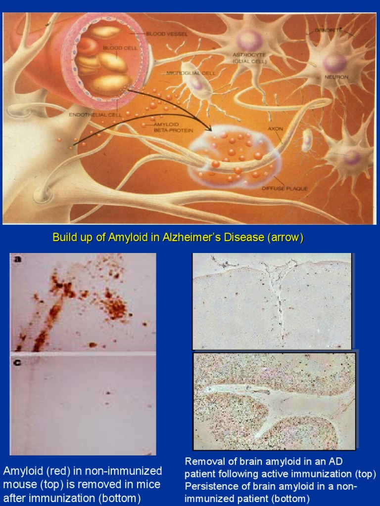 Build Up of Amyloid in Alzheimer's Disease (Arrow) | PDF | Science ...